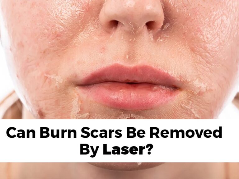 Can Burn scars be Removed by Laser? - Dr. PK Talwar Cosmetic Surgery Blogs
