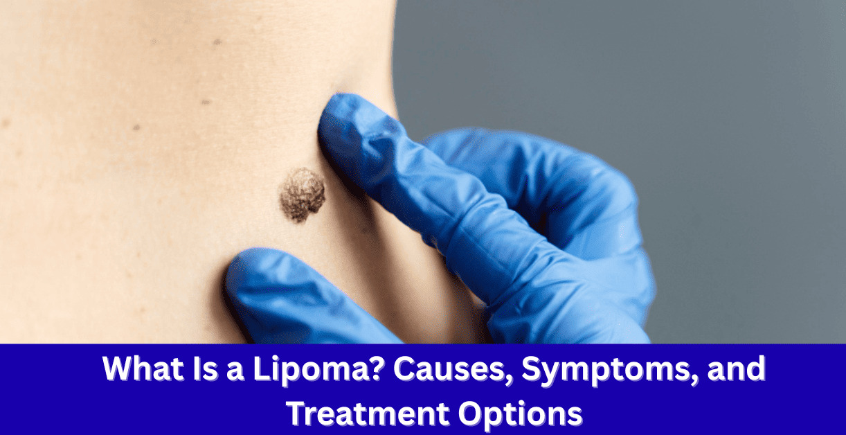 What Is a Lipoma? Causes, Symptoms, and Treatment Options