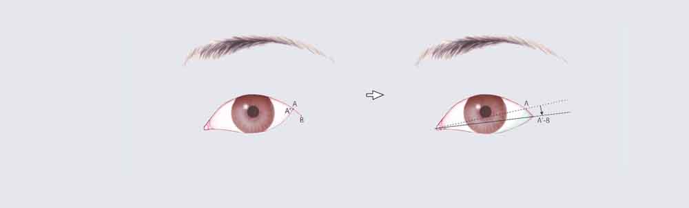 Lateral Canthoplasty Surgery in Delhi | Best Eyelid Surgery in India